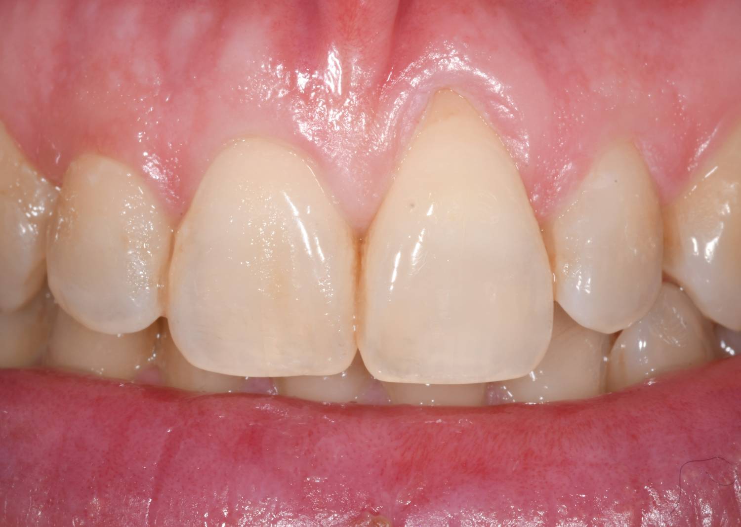 Recessione gengivale ed effetto Dracula | Dentista Dott. Fabio Ballestrasse